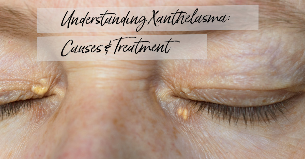 Understanding Xanthelasma: Causes and Treatment