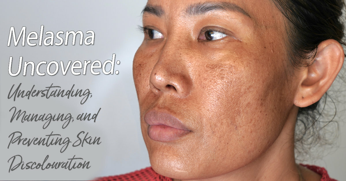 Melasma Uncovered: Understanding, Managing, and Preventing Skin Discoloration